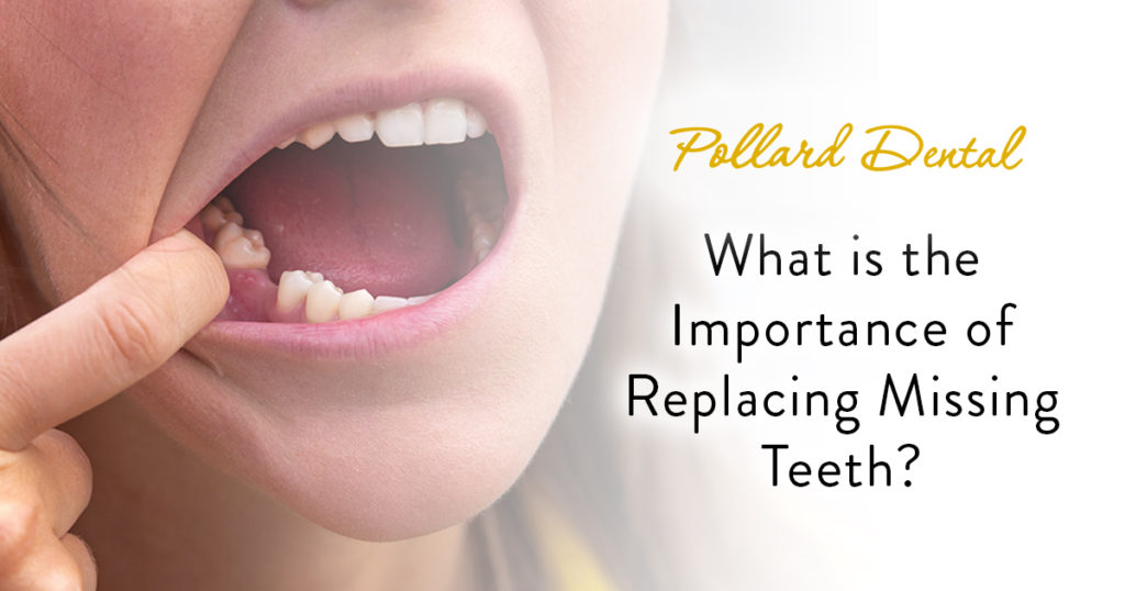 What Is The Importance Of Replacing Missing Teeth? - Pollard Dental