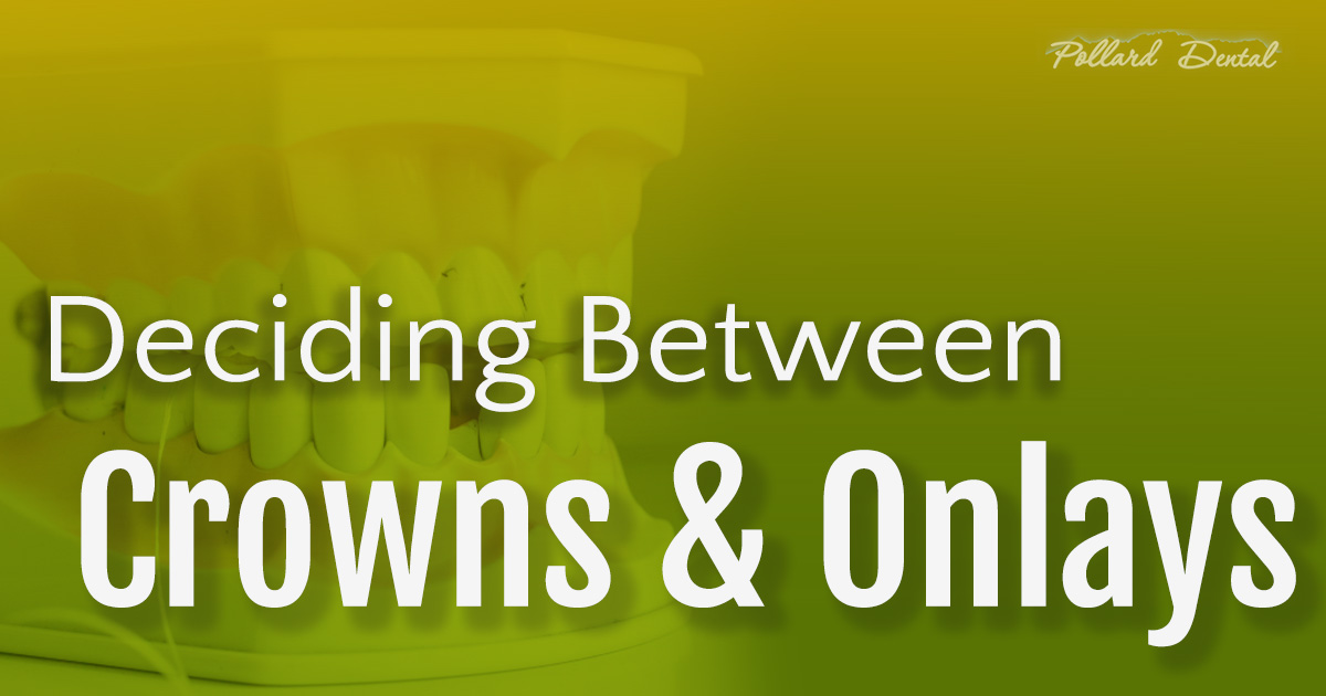 Crowns vs. Onlays | Silverdale, WA Dentist
